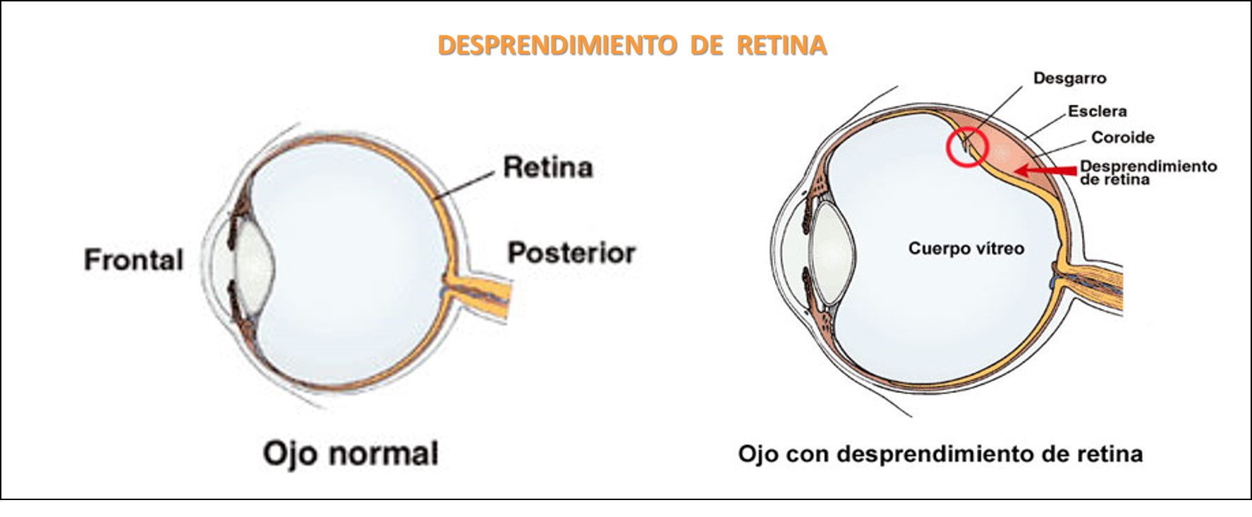 DESPRENDIMIENTO DE RETINA - Centro de la Visión